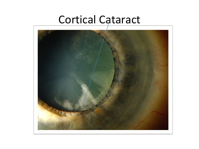 Cataract And Refractive Surgery