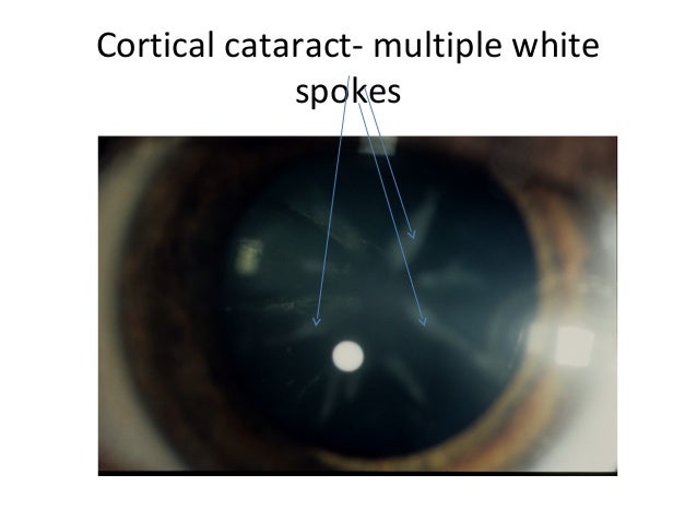 Cataract And Refractive Surgery