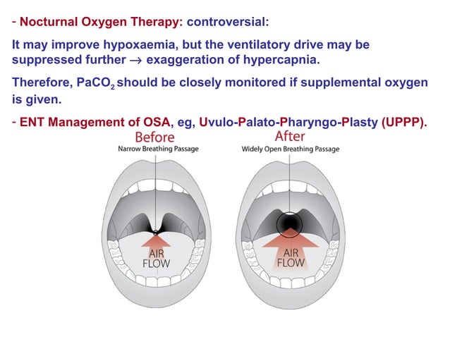 5 central and sleep related hypoventilation | PPT