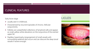 chlamydia and EYE | PPTX