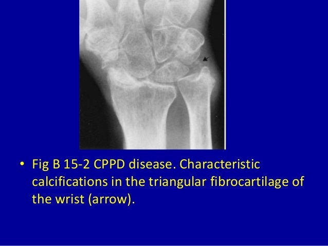 5 chondrocalcinosis CLINICAL IMAGAGING AN ATLAS OF DIFFERENTIAL DAIGN…