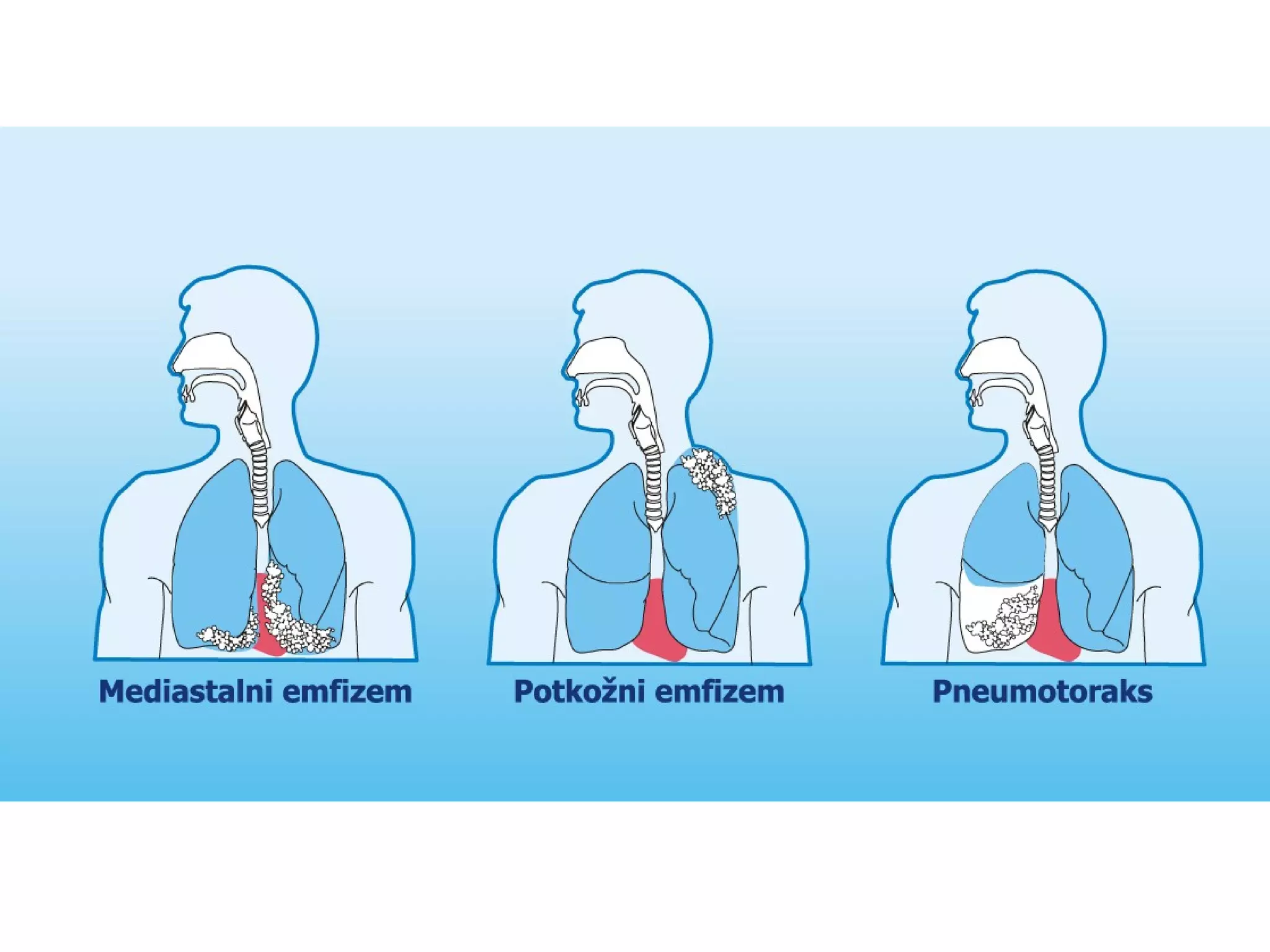 CMAS SOPAS program p3 bolesti | PPT