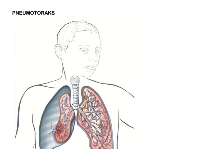 CMAS SOPAS program p3 bolesti | PPT