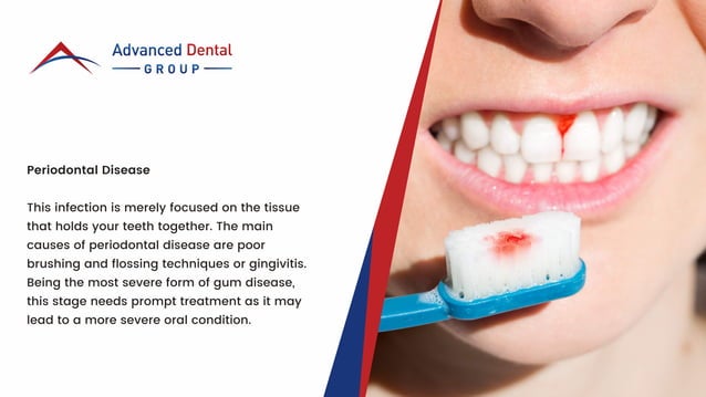 5 Common Dental And Oral Diseases Ppt
