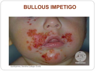 IMPETIGO- SKIN DISORDER-APOLLOJAMES | PPTX