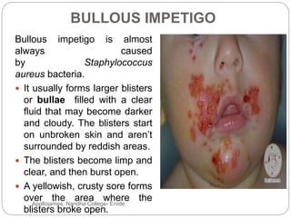 IMPETIGO- SKIN DISORDER-APOLLOJAMES | PPTX
