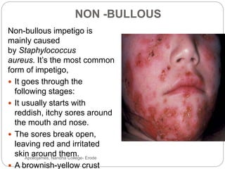 IMPETIGO- SKIN DISORDER-APOLLOJAMES | PPT