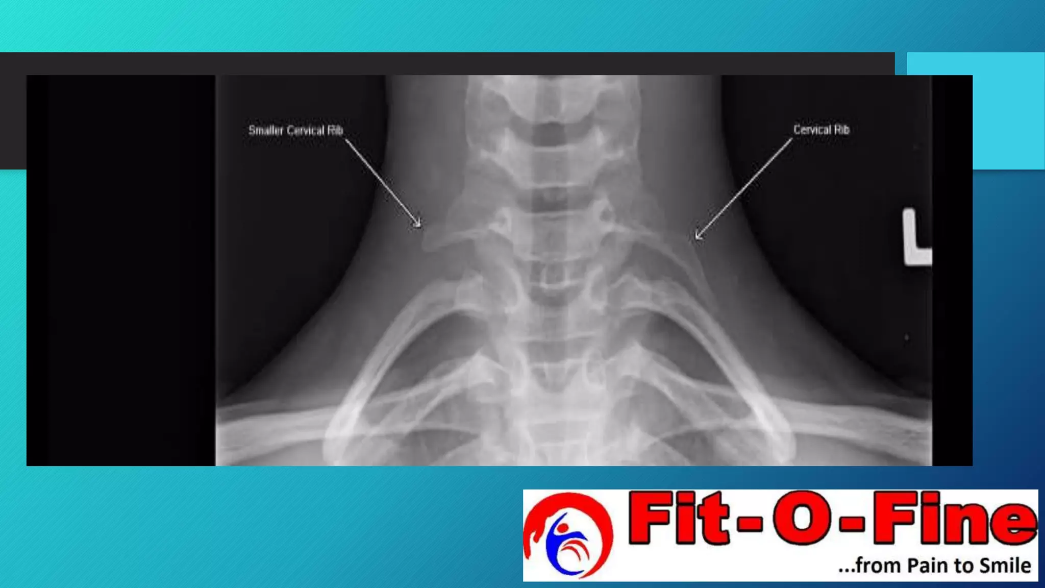 Cervical Rib | PPTX | Death, Injury, or Military Conflict | Sensitive ...