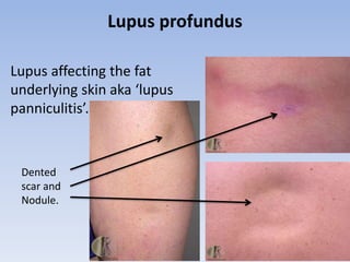 Lupus Profundus