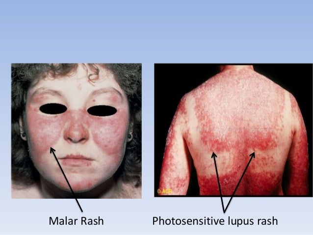 Systemic Lupus Erythematosus