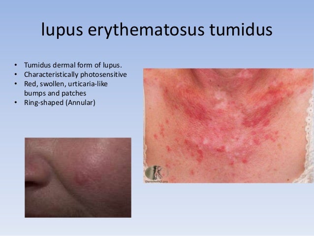 Systemic Lupus Erythematosus