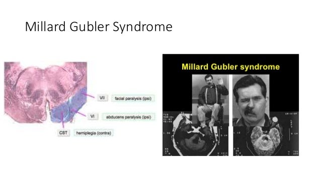 Differential Diagnosis in Lateral Rectus Palsy
