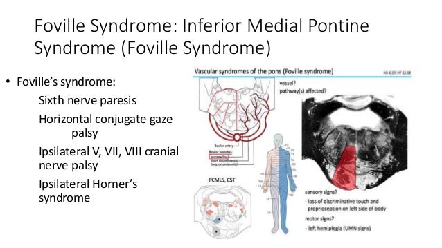 Differential Diagnosis in Lateral Rectus Palsy