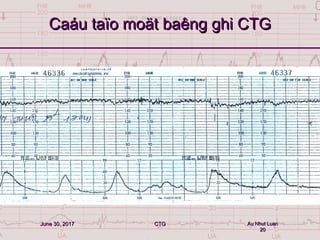 CTG ( EFM ) | PPT