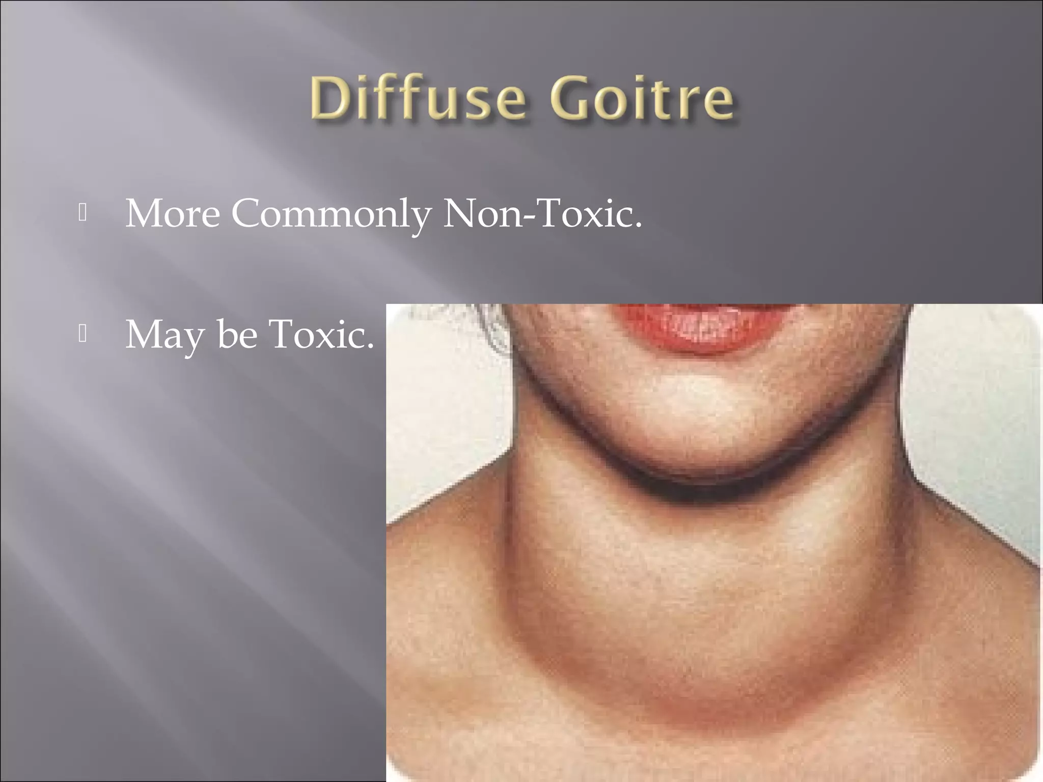 diffuse toxic & endemic goiter | PPT