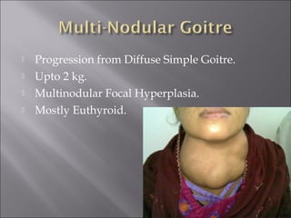 diffuse toxic & endemic goiter | PPT