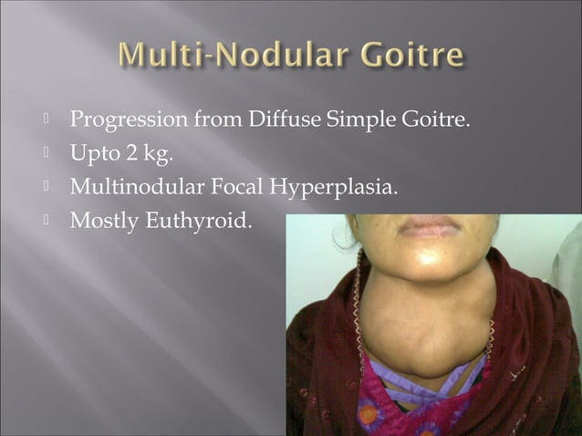 diffuse toxic & endemic goiter | PPT | Thyroid Disorders | Endocrine ...