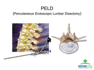 5 dr daya-thirumala-rao-ambulatory-spine-surgery_ncas_2011 | PPT