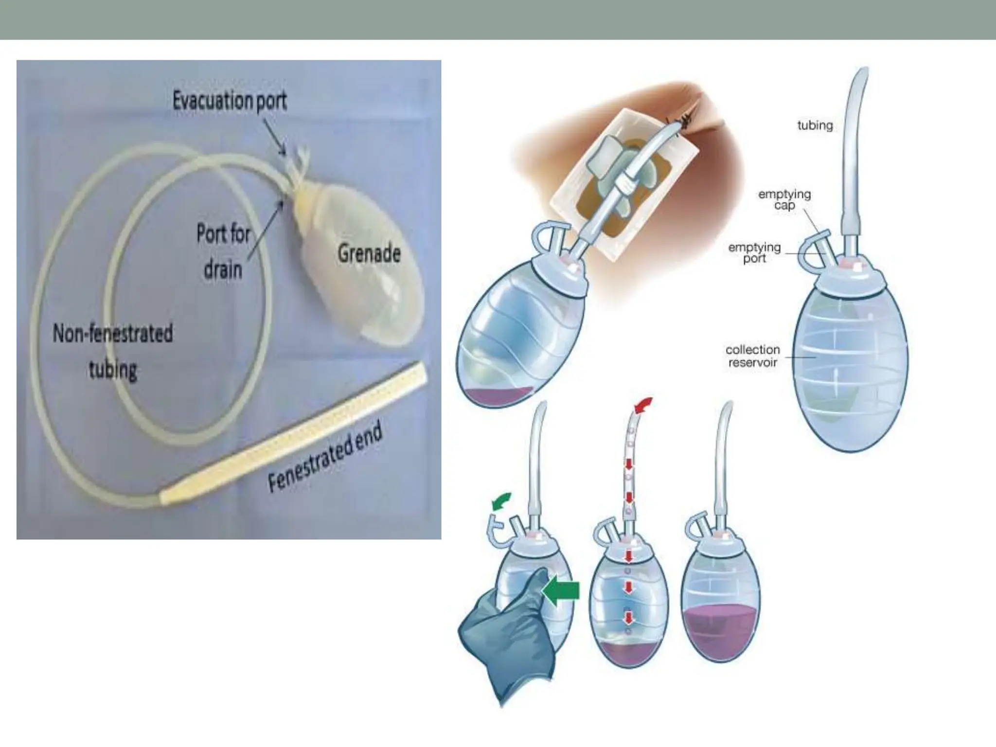 Drains & tubes used in surgery.pptx