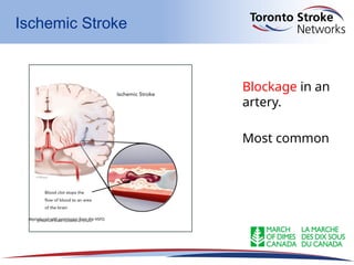 Stroke and its physical effects ppt.pptx
