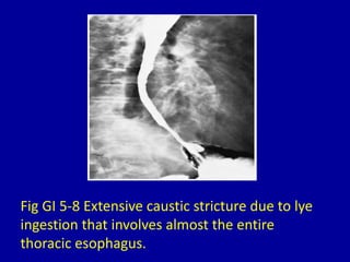 5 esophageal narrowing | PPTX