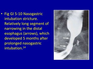 5 esophageal narrowing | PPTX