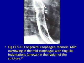 5 esophageal narrowing | PPTX