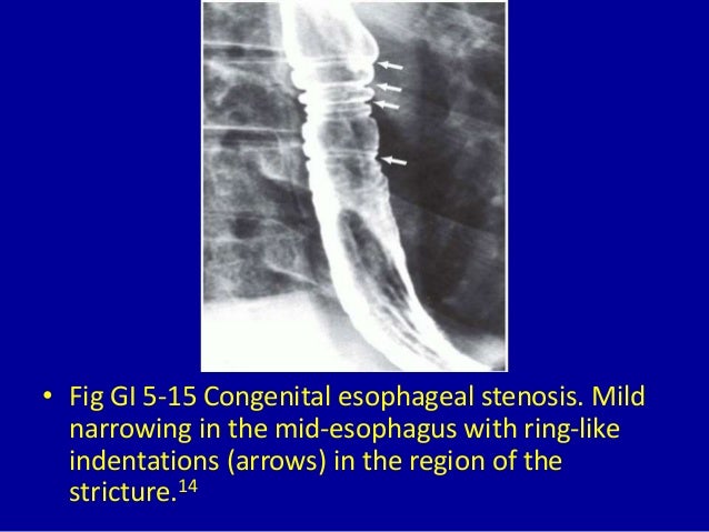 5 esophageal narrowing