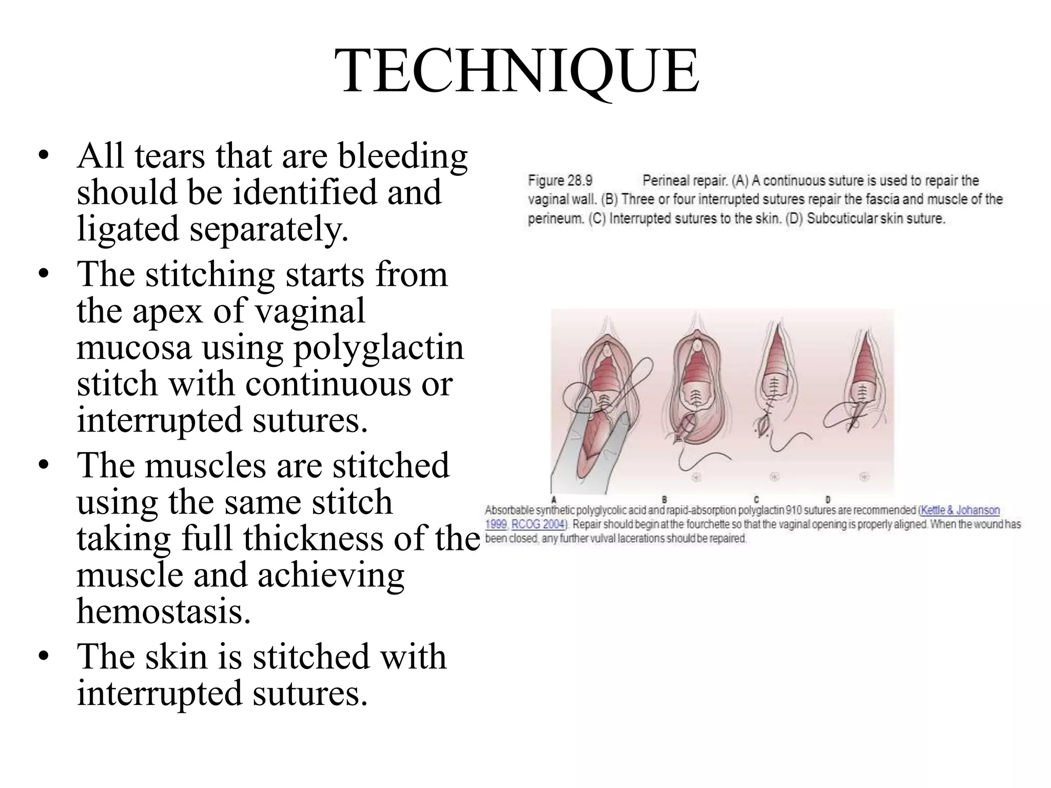 presentaion on perineal tear | PPTX