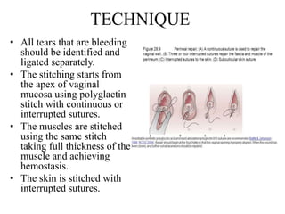 presentaion on perineal tear | PPT