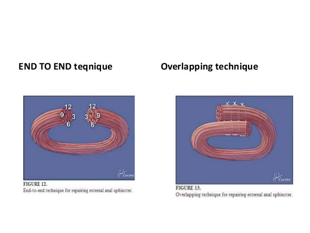 presentaion on perineal tear