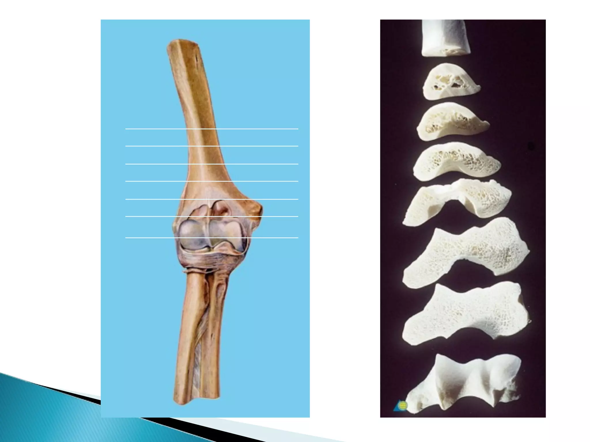 5 fx humero distal adultos Dr. Miguel Mite | PPT