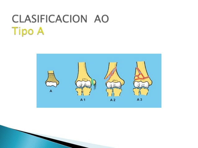 5 fx humero distal adultos Dr. Miguel Mite | PPT