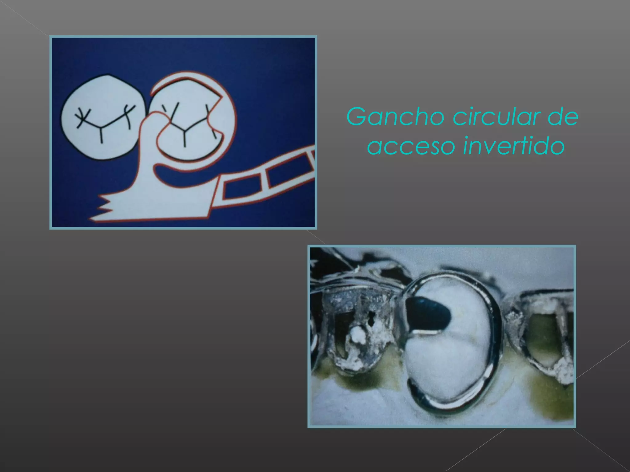 5 ganchos de protesis parcial removible | PPT