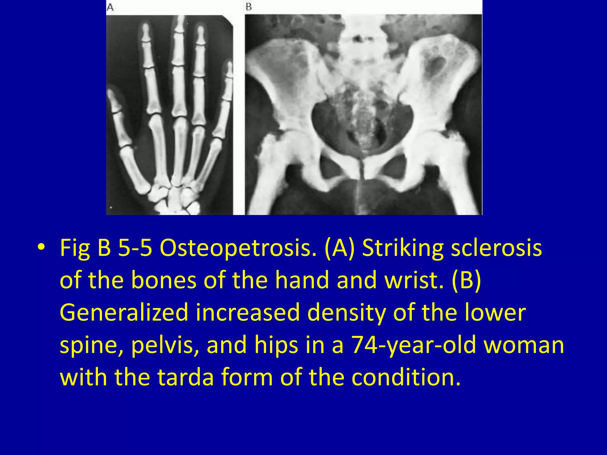 5 generalized osteosclerosis | PPTX