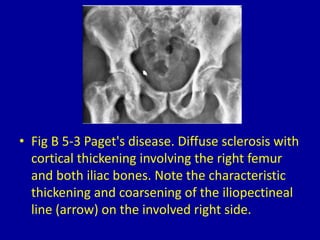 5 generalized osteosclerosis | PPTX