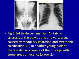 5 generalized osteosclerosis | PPTX
