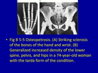 5 generalized osteosclerosis | PPTX