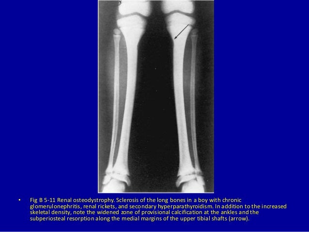 5 generalized osteosclerosis