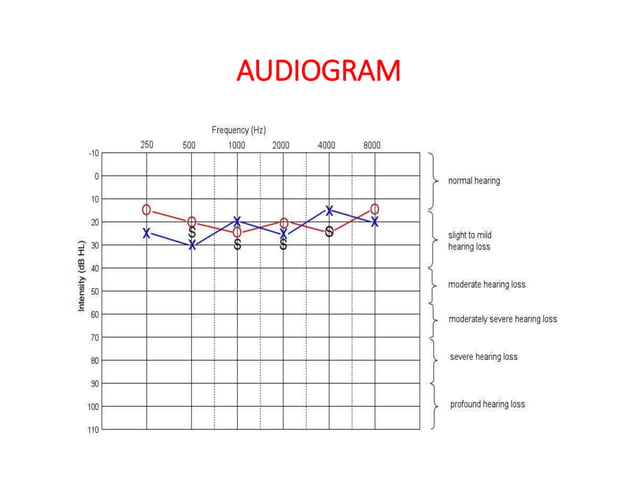 FUNCTIONAL ASSESSMENT OF HEARING & VESTIBULAR FUNCTION TESTS | PPTX ...
