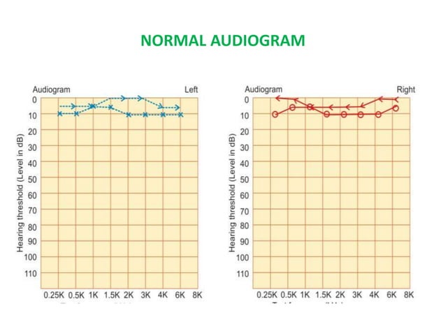 FUNCTIONAL ASSESSMENT OF HEARING & VESTIBULAR FUNCTION TESTS | PPTX ...
