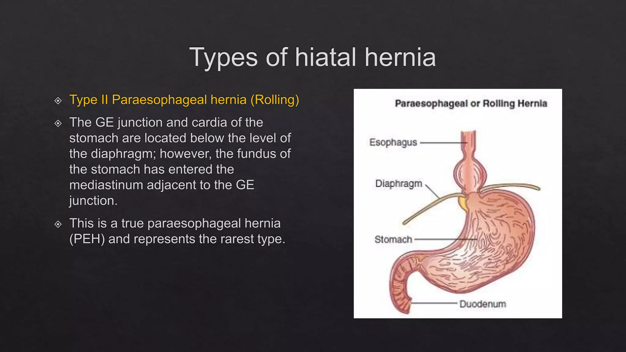 Hiatal hernia | PPT