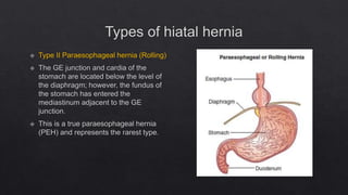 Hiatal hernia | PPTX