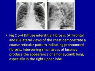 5 honeycombing | PPTX