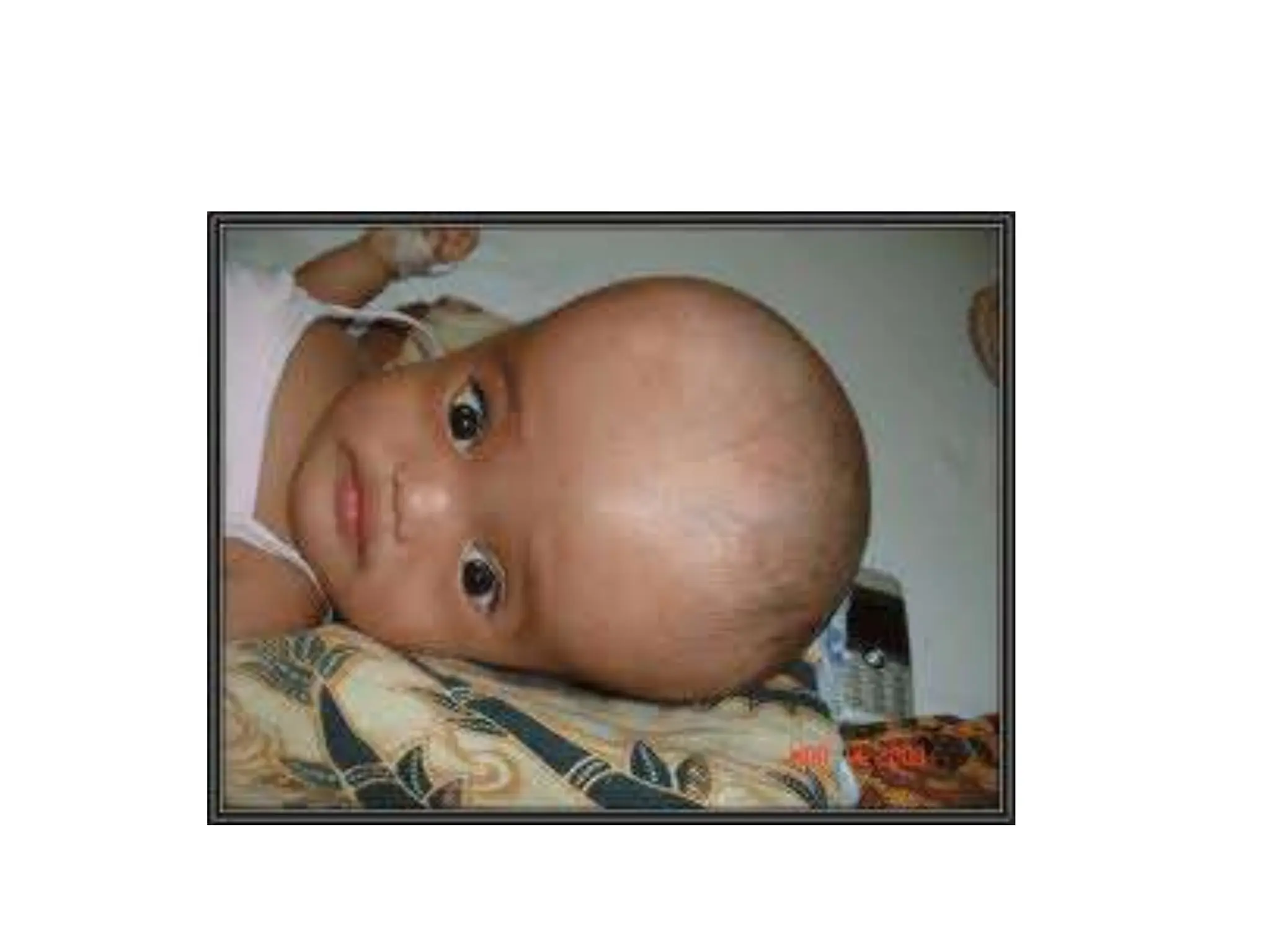 5 Hydrocephalus.pptx children brain enlarge | PPT
