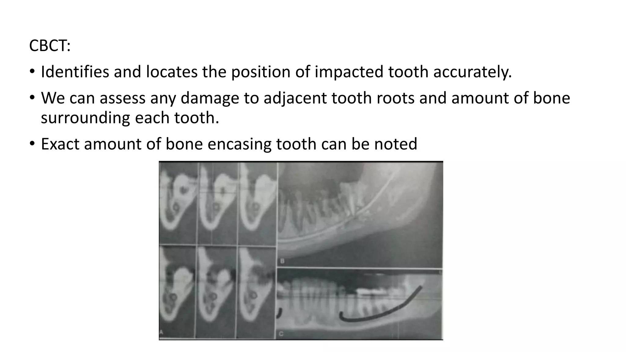 Impaction preoperative assessment.pptx