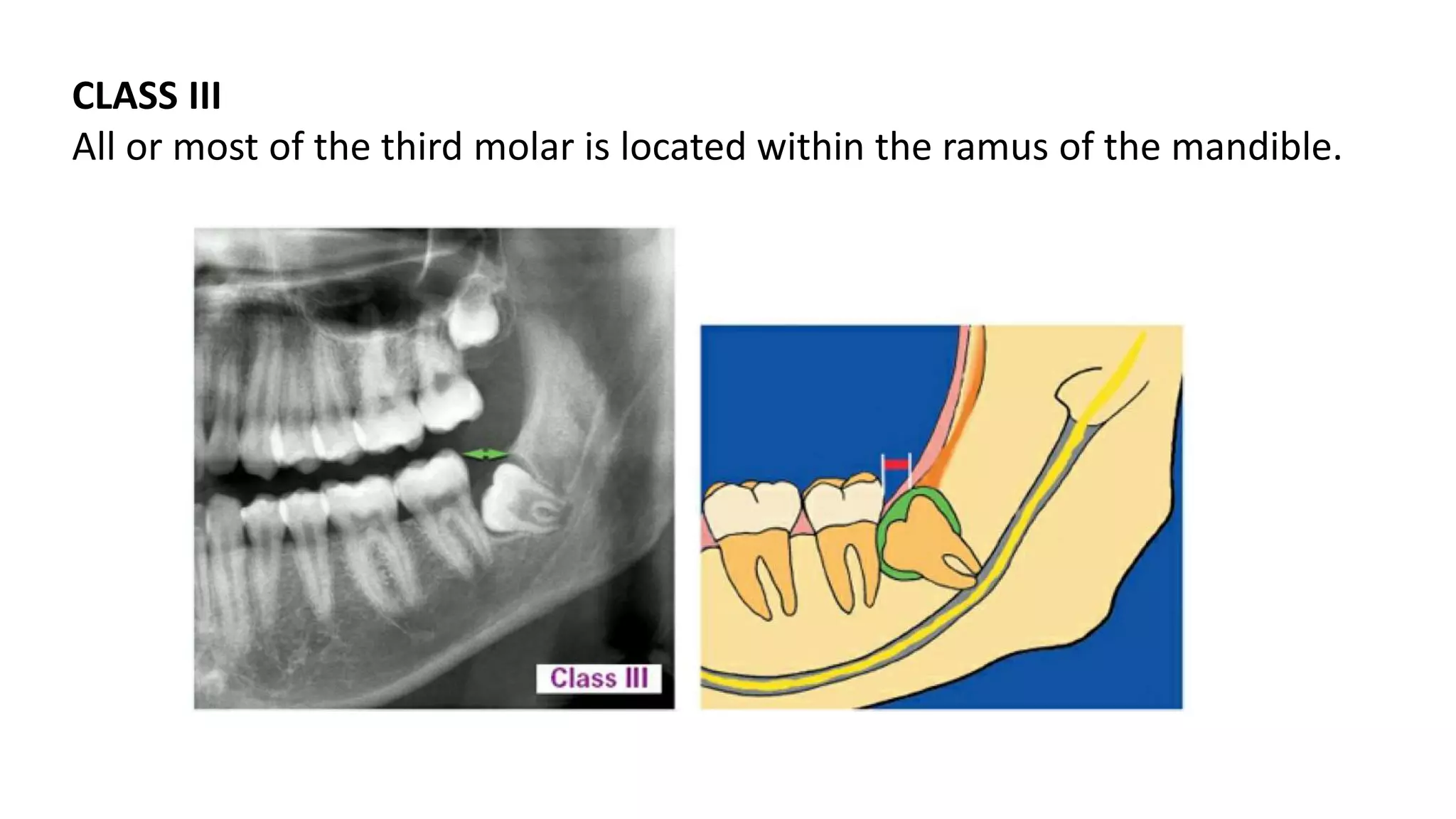 Impaction preoperative assessment.pptx