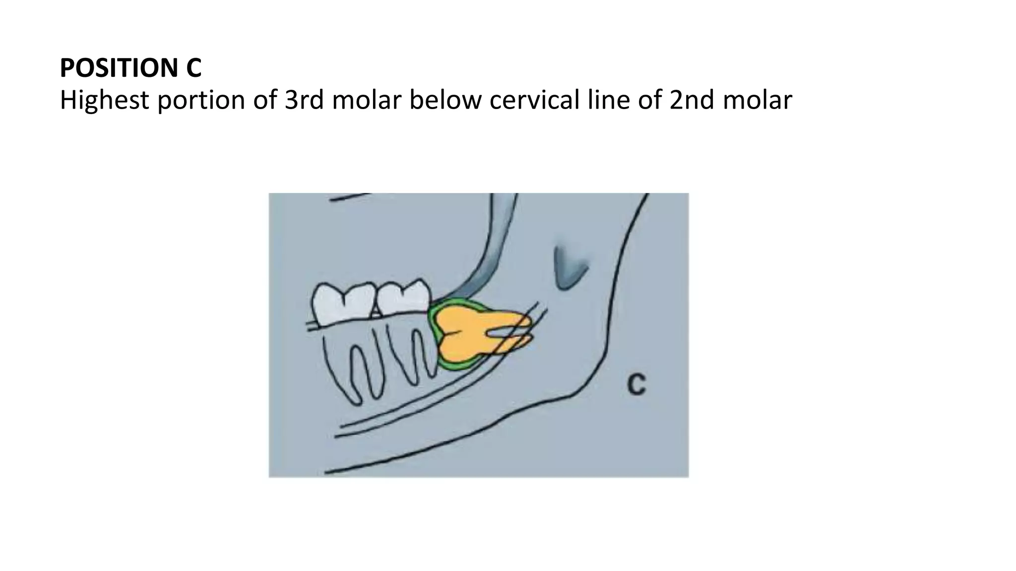 Impaction preoperative assessment.pptx