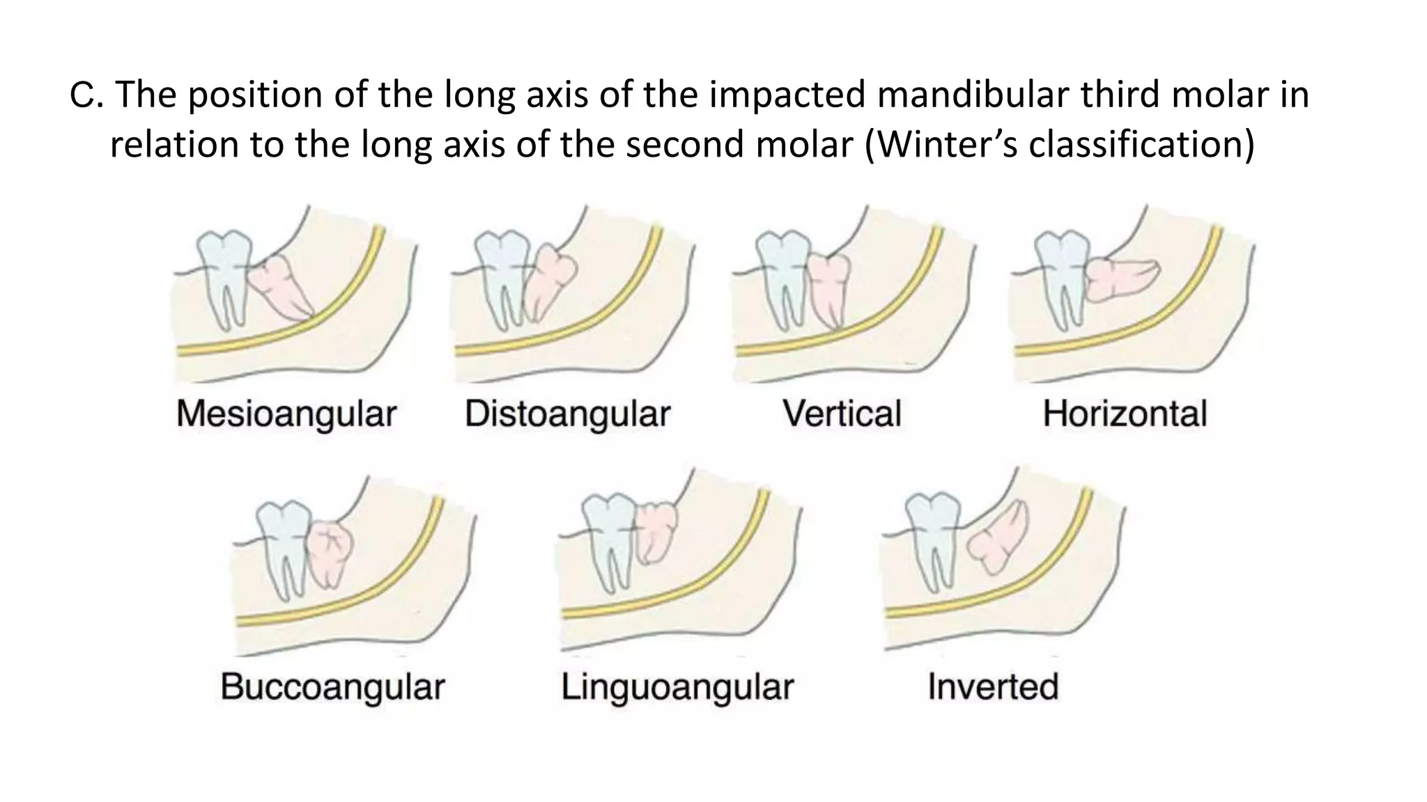 Impaction preoperative assessment.pptx