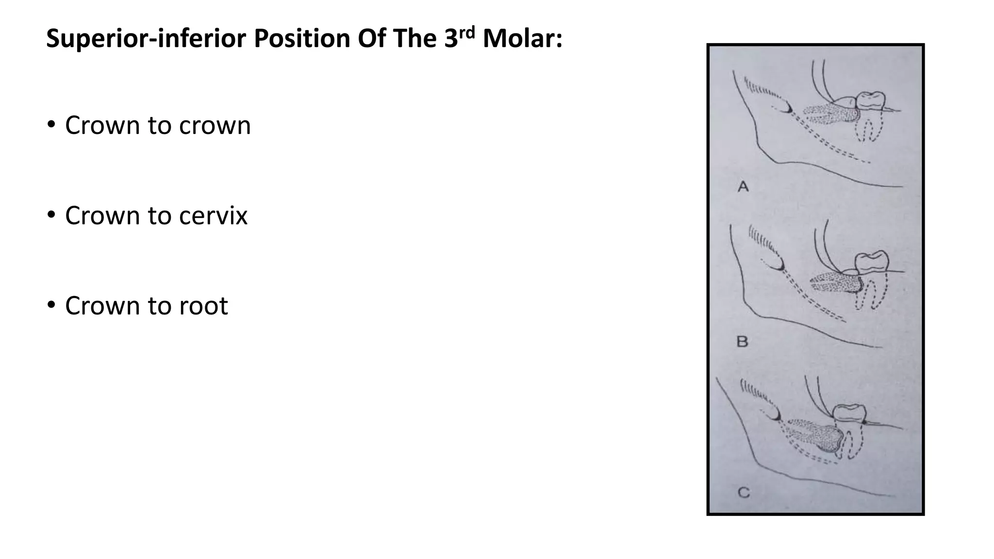 Impaction preoperative assessment.pptx